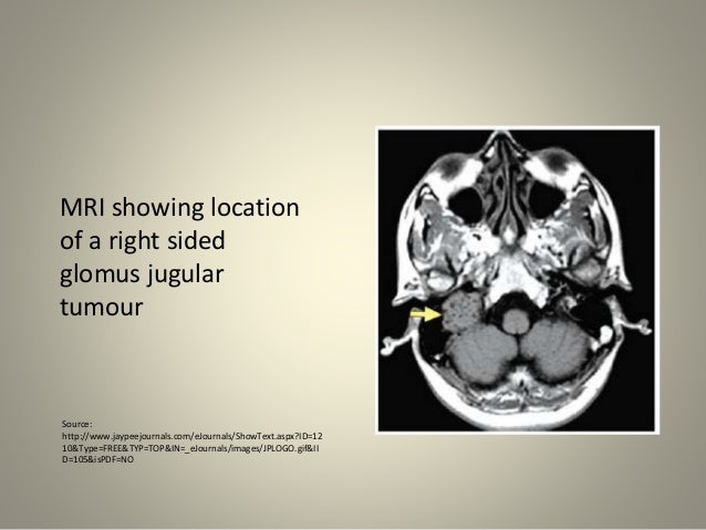 Personal journey with a glomus jugulare tumour2