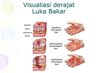 Pert.-14_Manajemen-Luka-Bakar (1).ppt