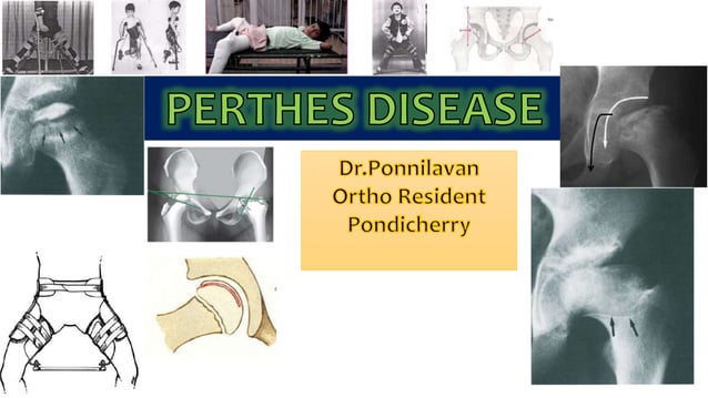 Perthes disease | PPTX | Bone and Joint Conditions | Diseases and ...