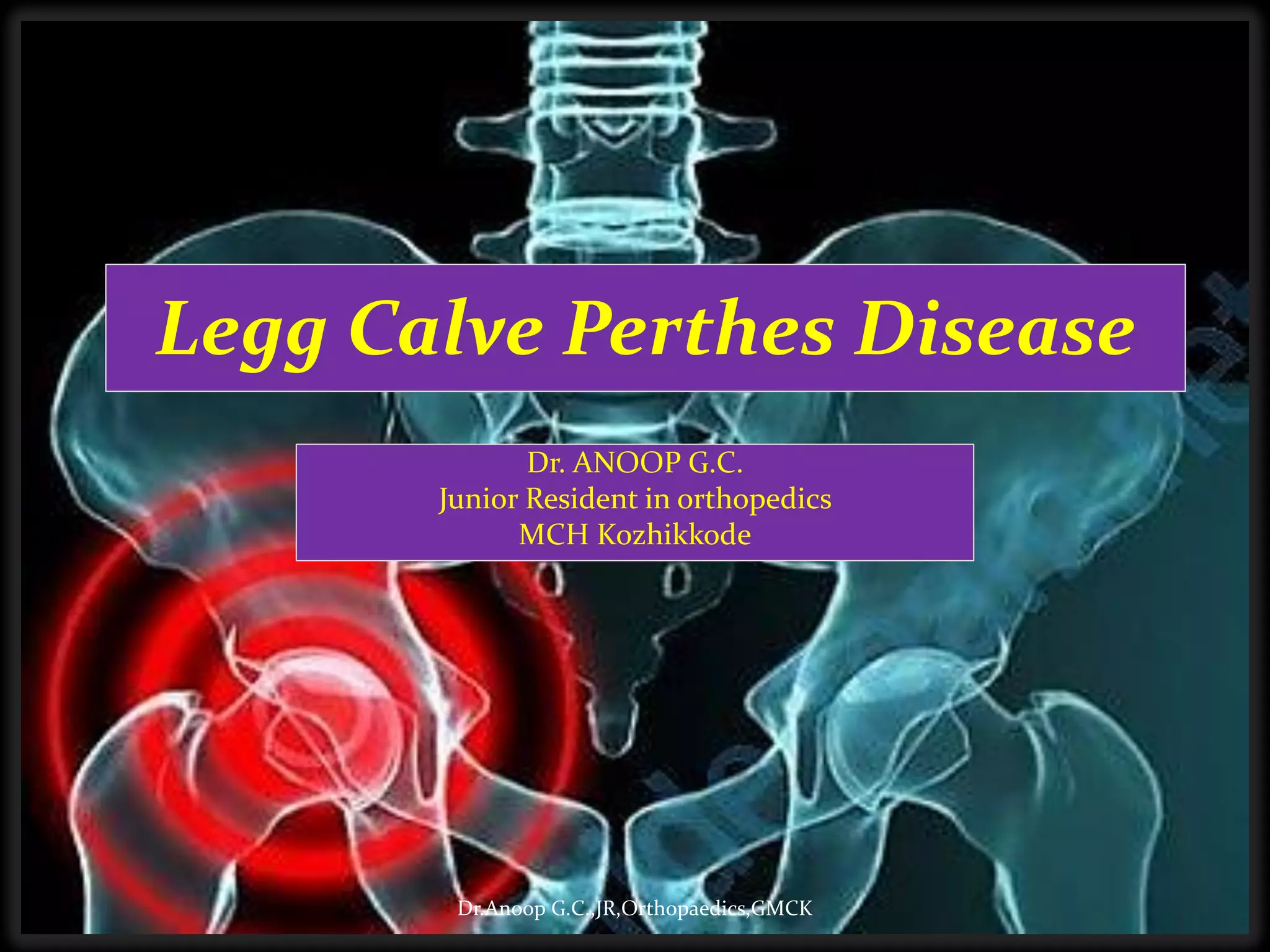 Perthes Disease LCPD | PDF