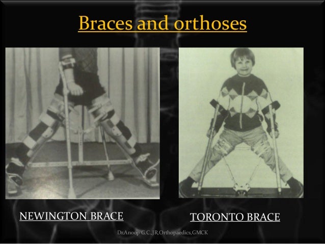 Perthes Disease LCPD