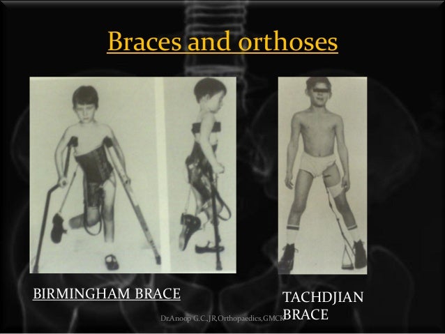 Perthes Disease LCPD