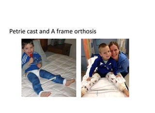 Perthes disease | PPTX