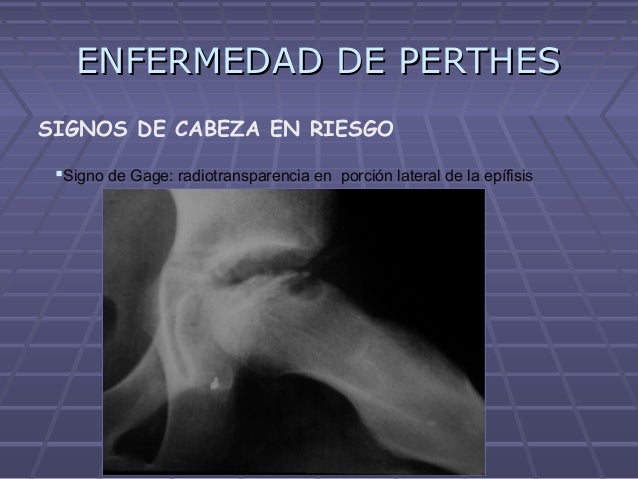 Perthes upap