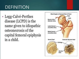 Slipped Capital Femoral Epiphysis Vs Legg Calve Perthes Disease