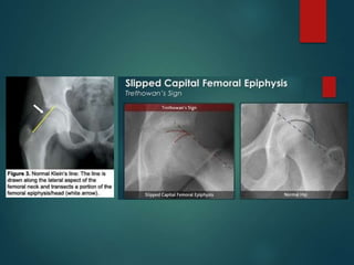 Slipped Capital Femoral Epiphysis Vs Legg Calve Perthes Disease