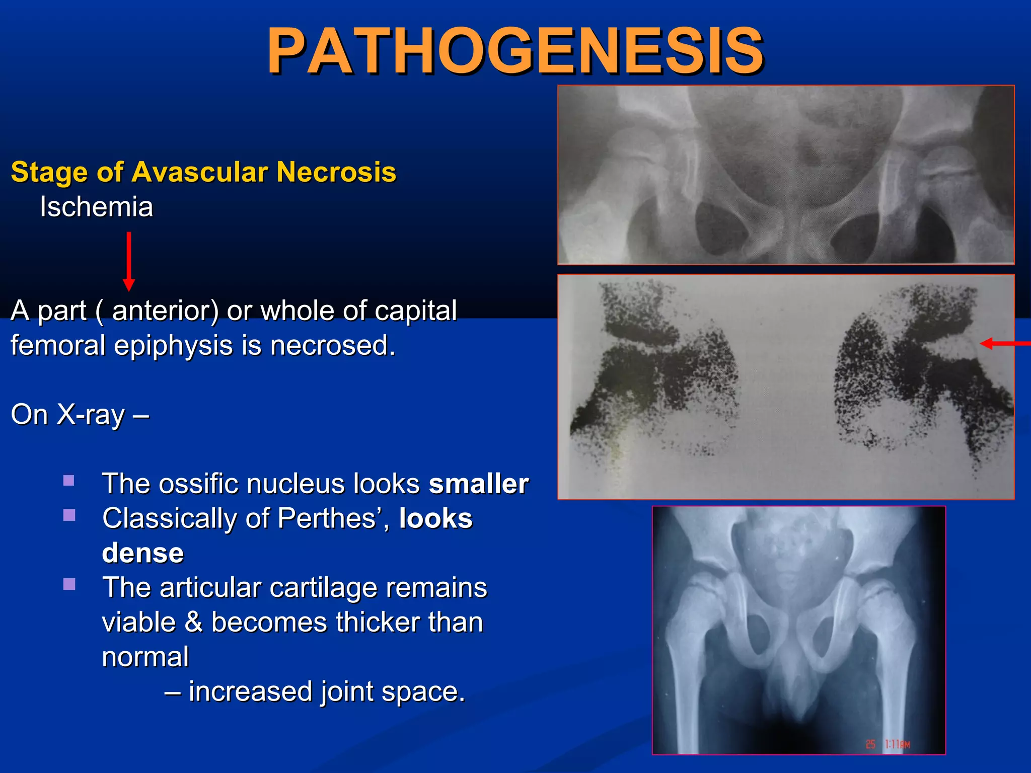 Perthes ’ disease | PPT