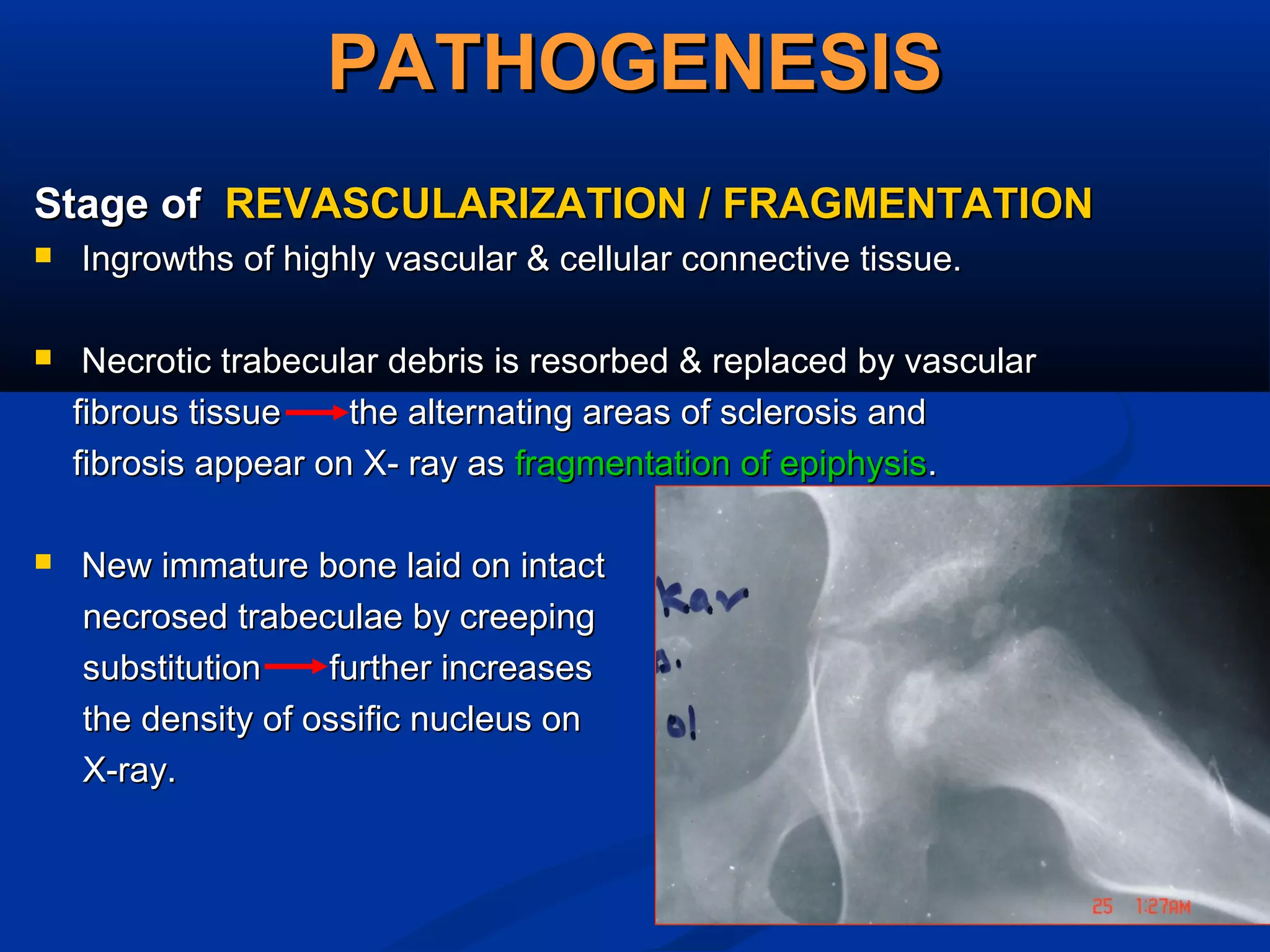 Perthes ’ disease | PPT