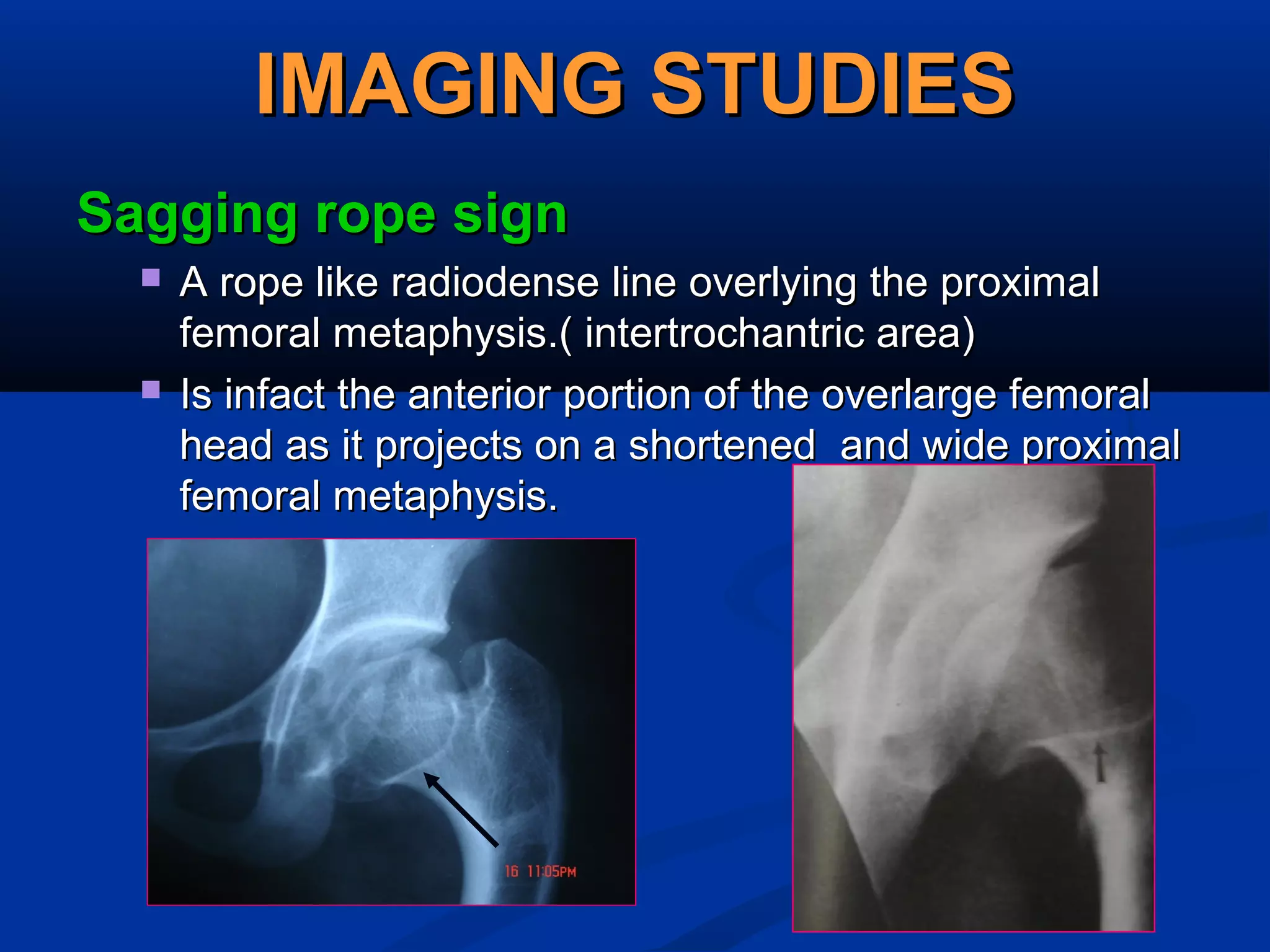 Perthes ’ disease | PPT