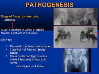 Perthes ’ disease | PPT