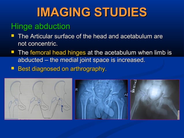 Perthes ’ disease | PPT