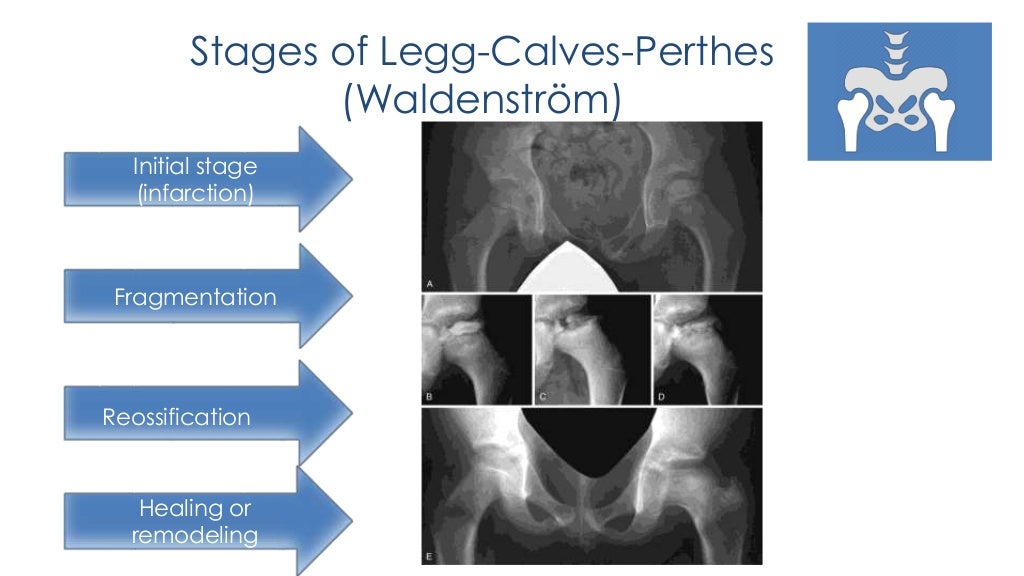 legg-calve-perthes-disease