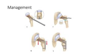 Perthes disease | PPT