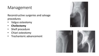 Perthes disease | PPT