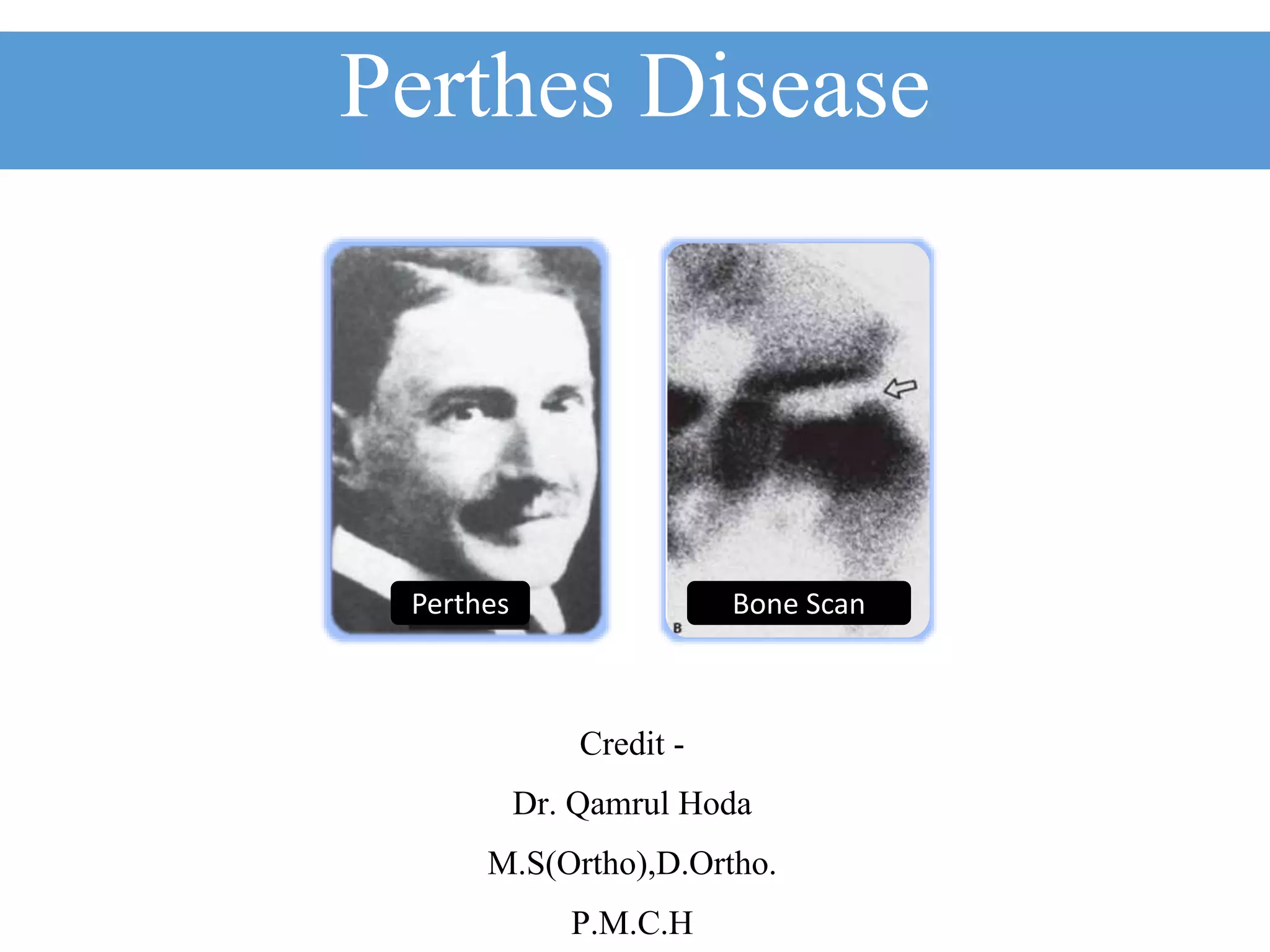 Perthes disease | PPTX