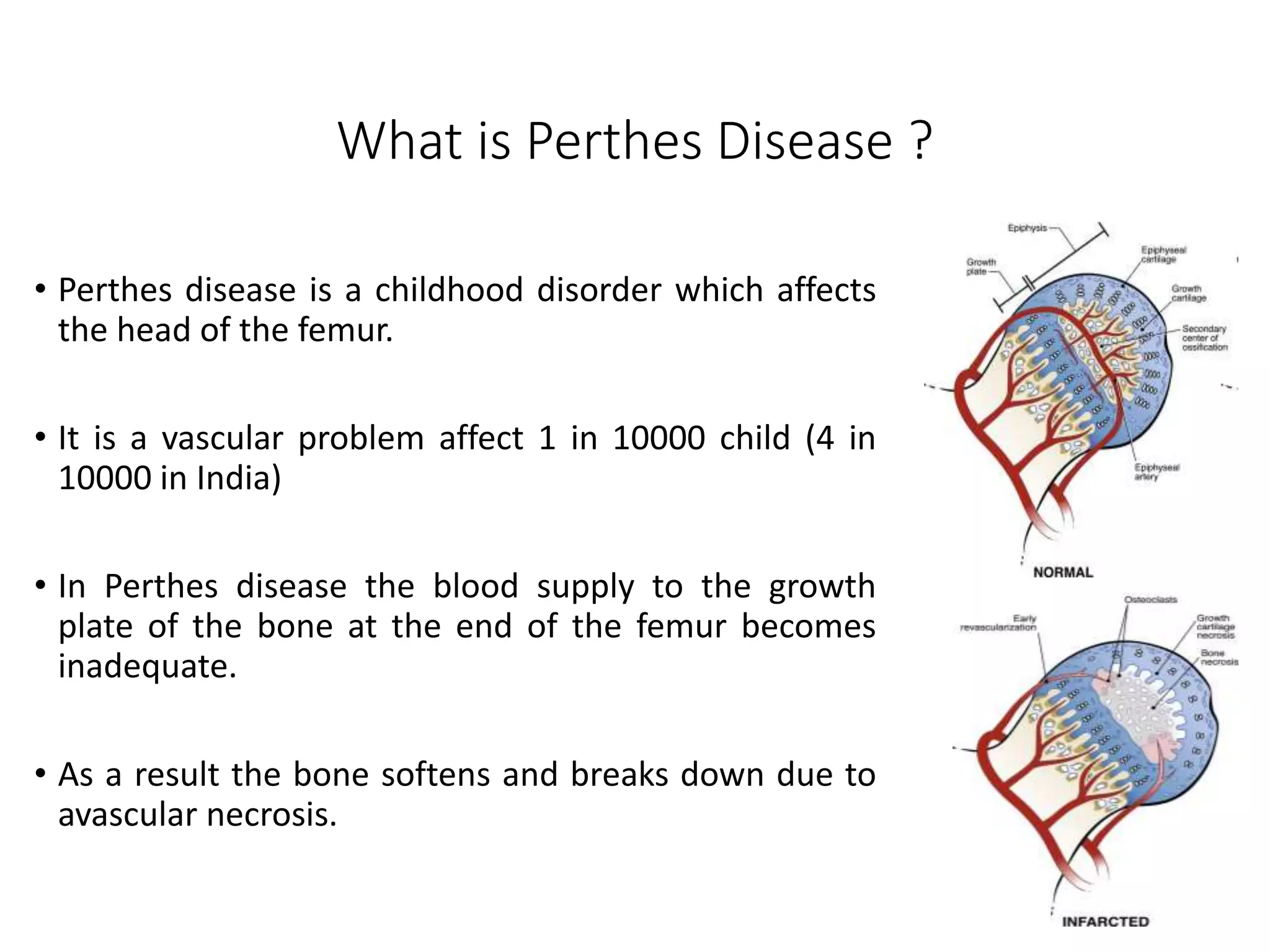 Perthes disease | PPTX