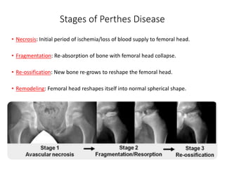 Perthes disease | PPTX