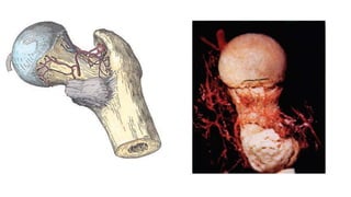 Legg Calve Perthes disease | PPTX