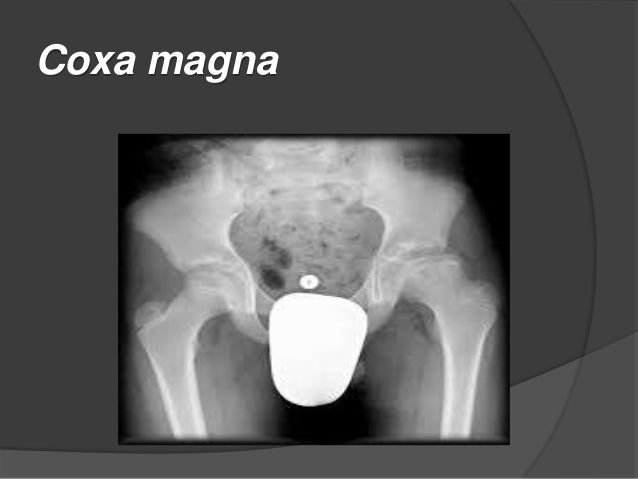 Perthes disease in children