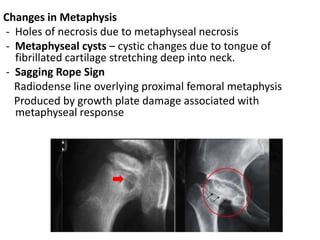 PERTHES DISEASE | PPTX