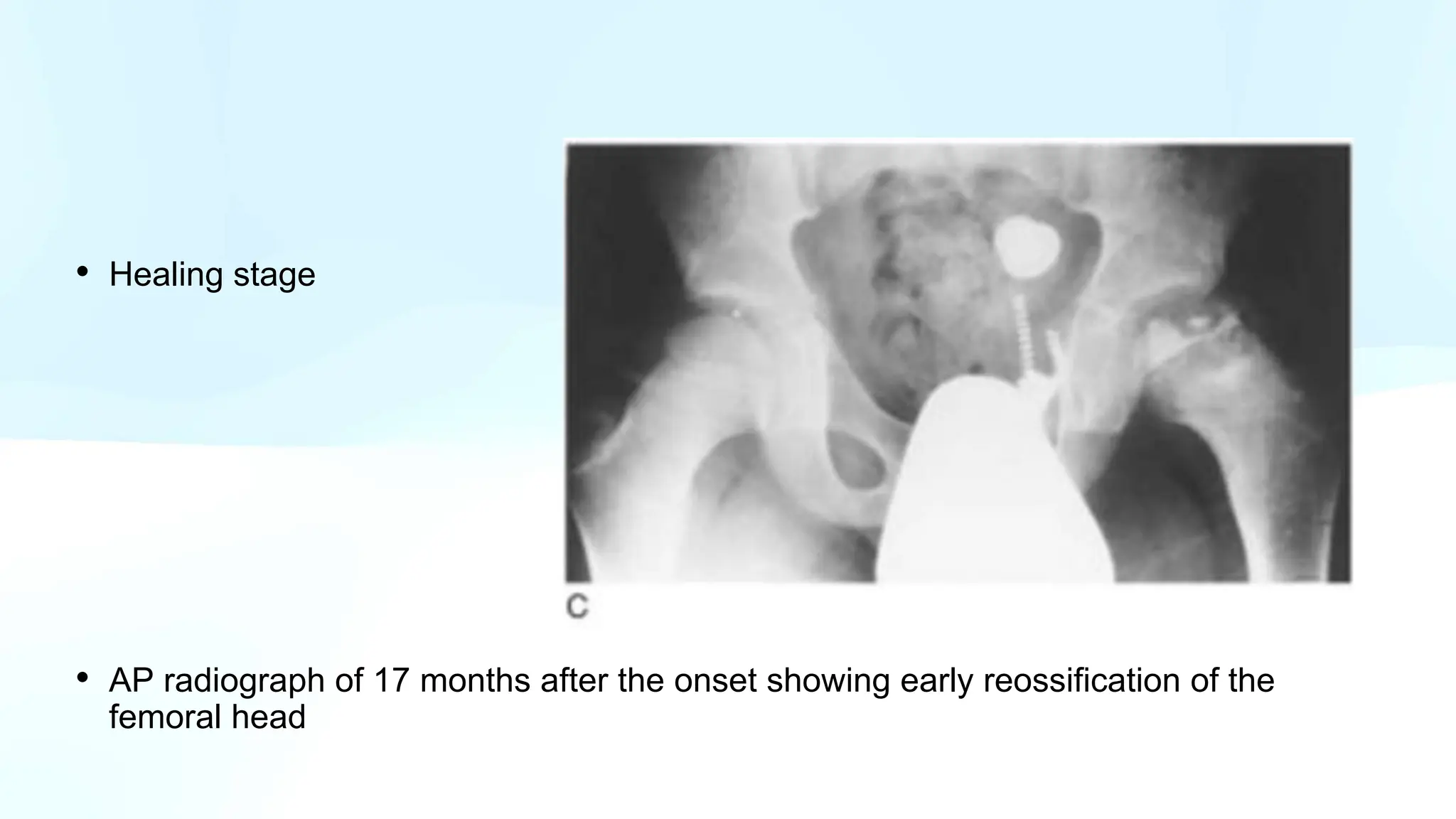 Perthes disease,an elaborate lecture.pptx