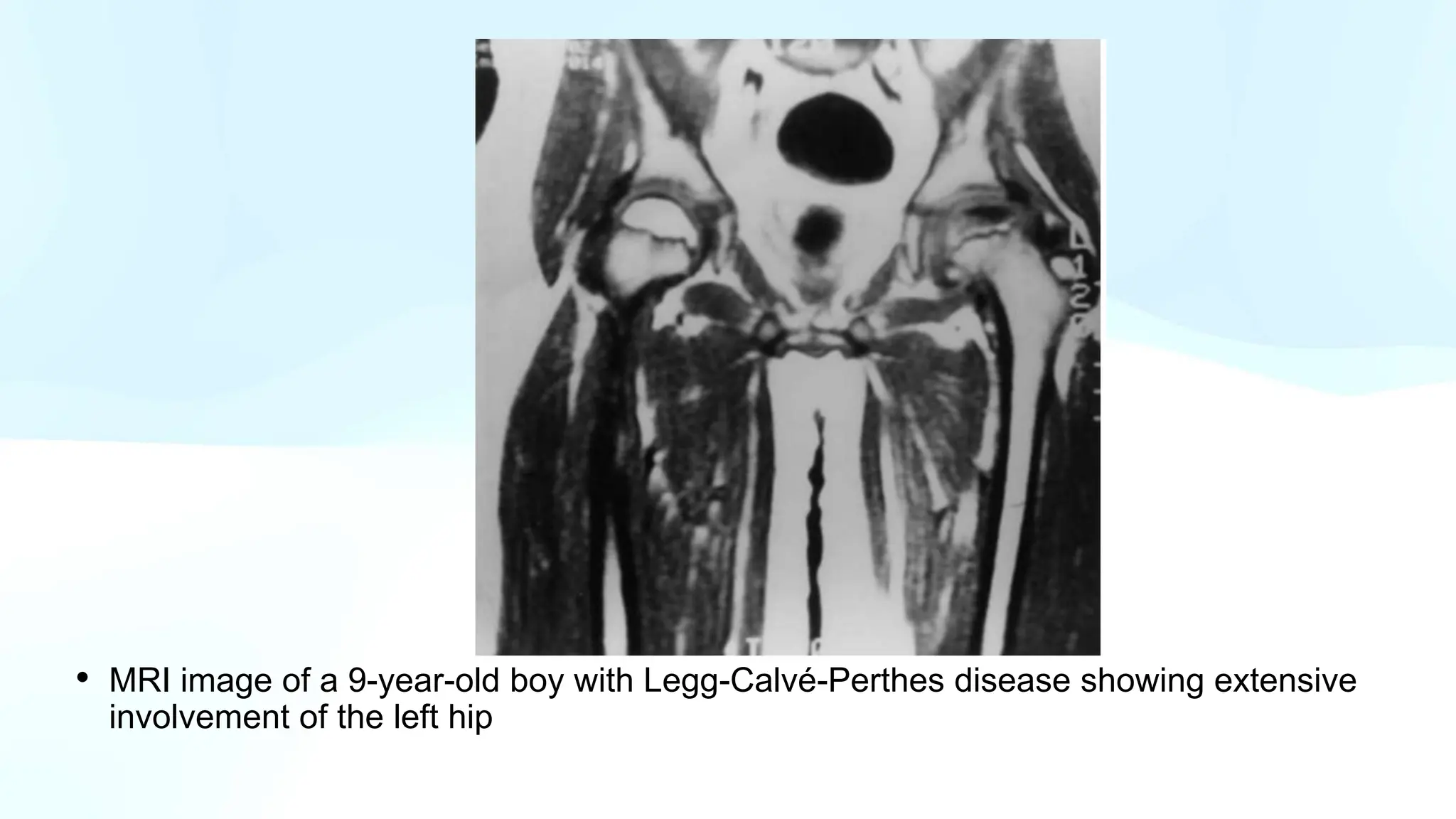 Perthes disease,an elaborate lecture.pptx