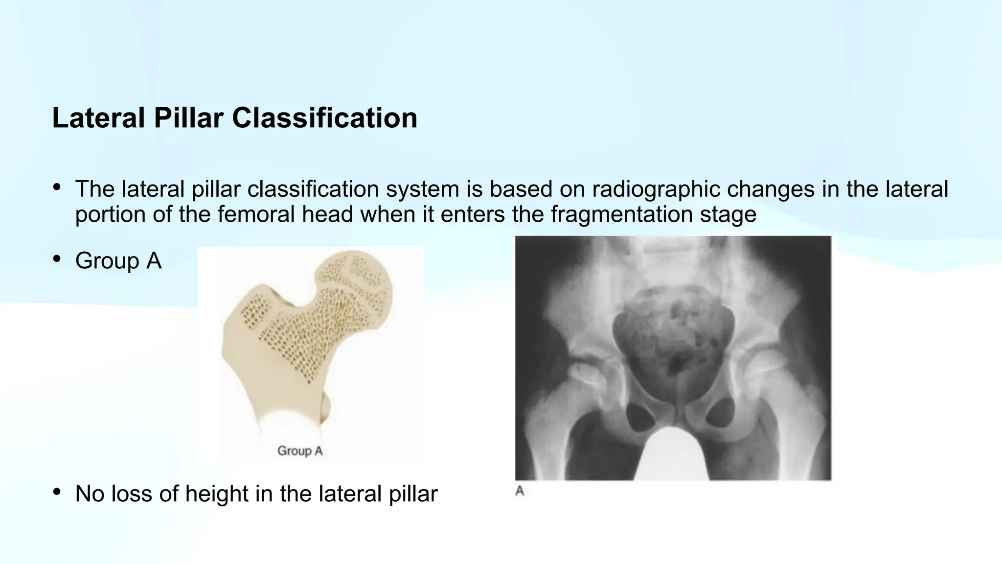 Perthes disease,an elaborate lecture.pptx