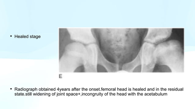 Perthes disease,an elaborate lecture.pptx