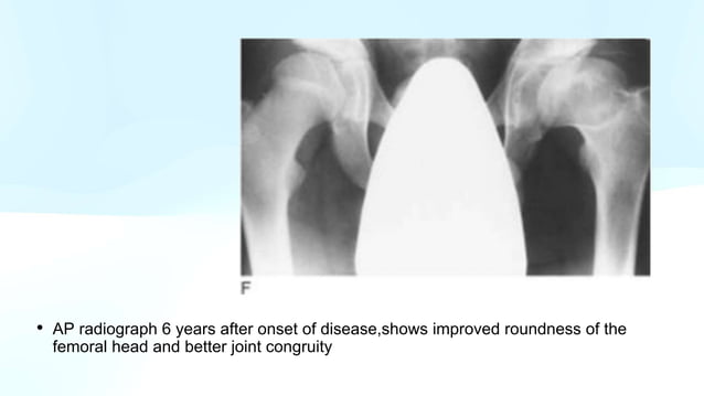 Perthes disease,an elaborate lecture.pptx