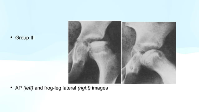 Perthes disease,an elaborate lecture.pptx