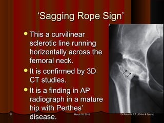 Perthes disease by DR.NAVEEN RATHOR | PPT