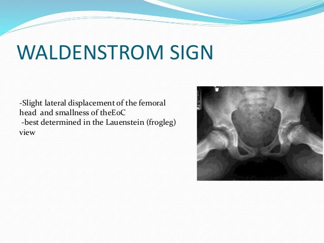 Leg Calve Perthes disease