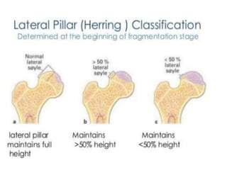 Perthes disease | PPTX
