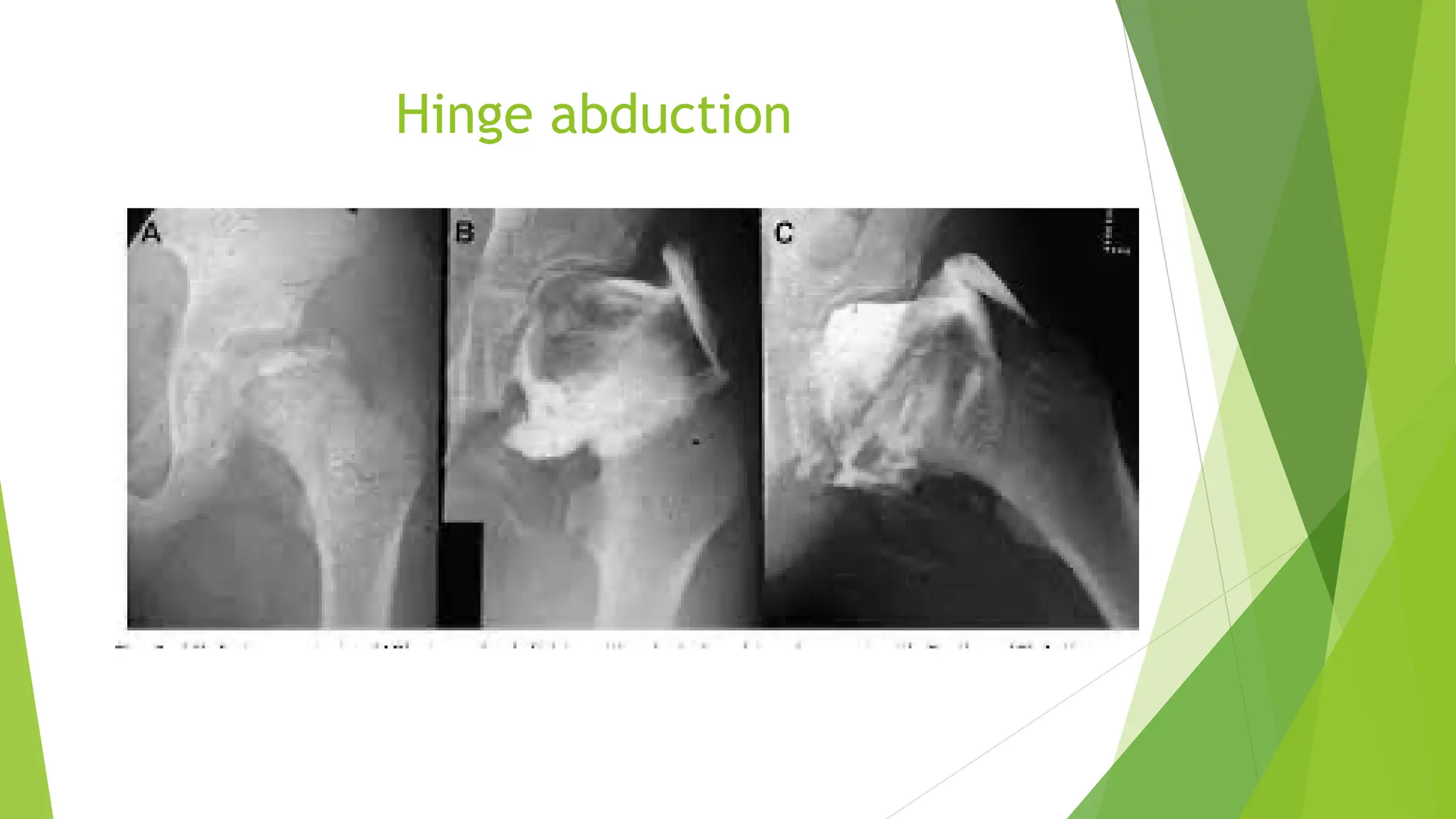 LEGG CALVE PERTHES IN PAEDIATRIC PATIENTS.pptx