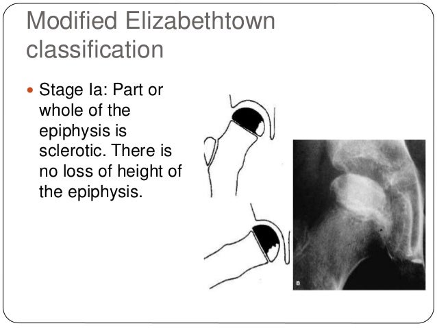 CURRENT TRENDS IN MANAGEMENT OF PERTHES DISEASE BY DR.GIRISH MOTWANI