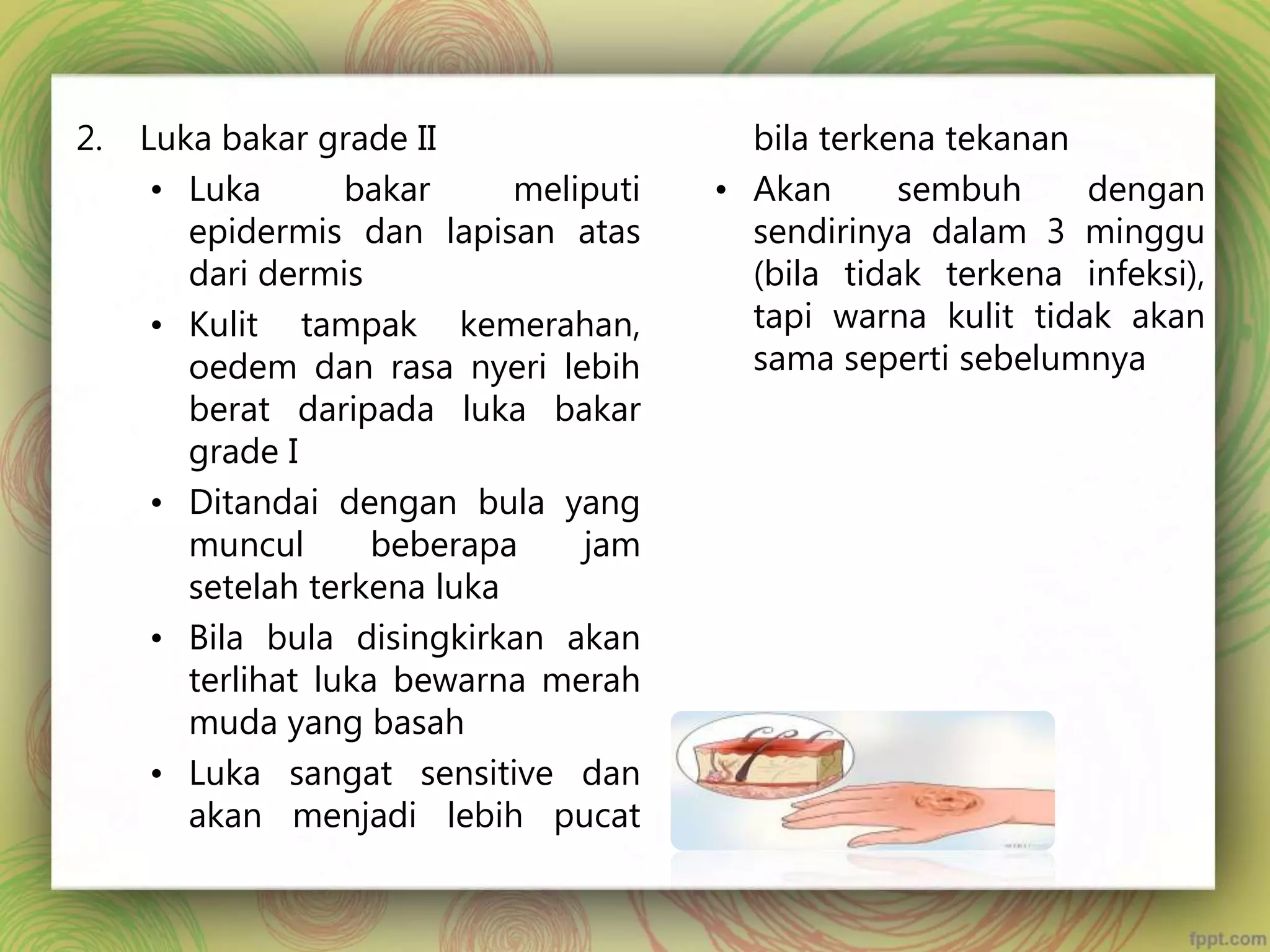 pertolongan_pertama_pada_luka_bakar.pptx