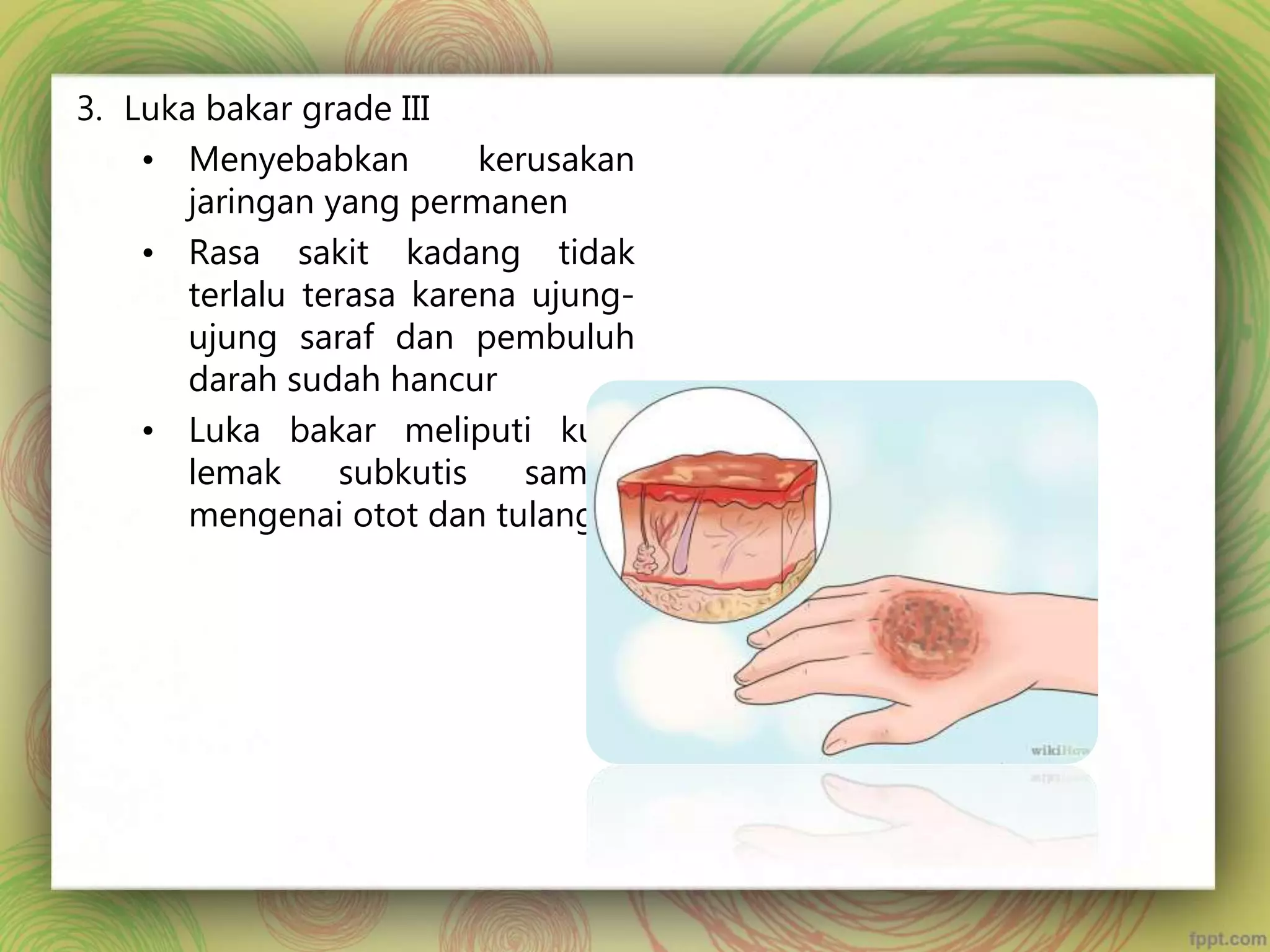 pertolongan_pertama_pada_luka_bakar.pptx