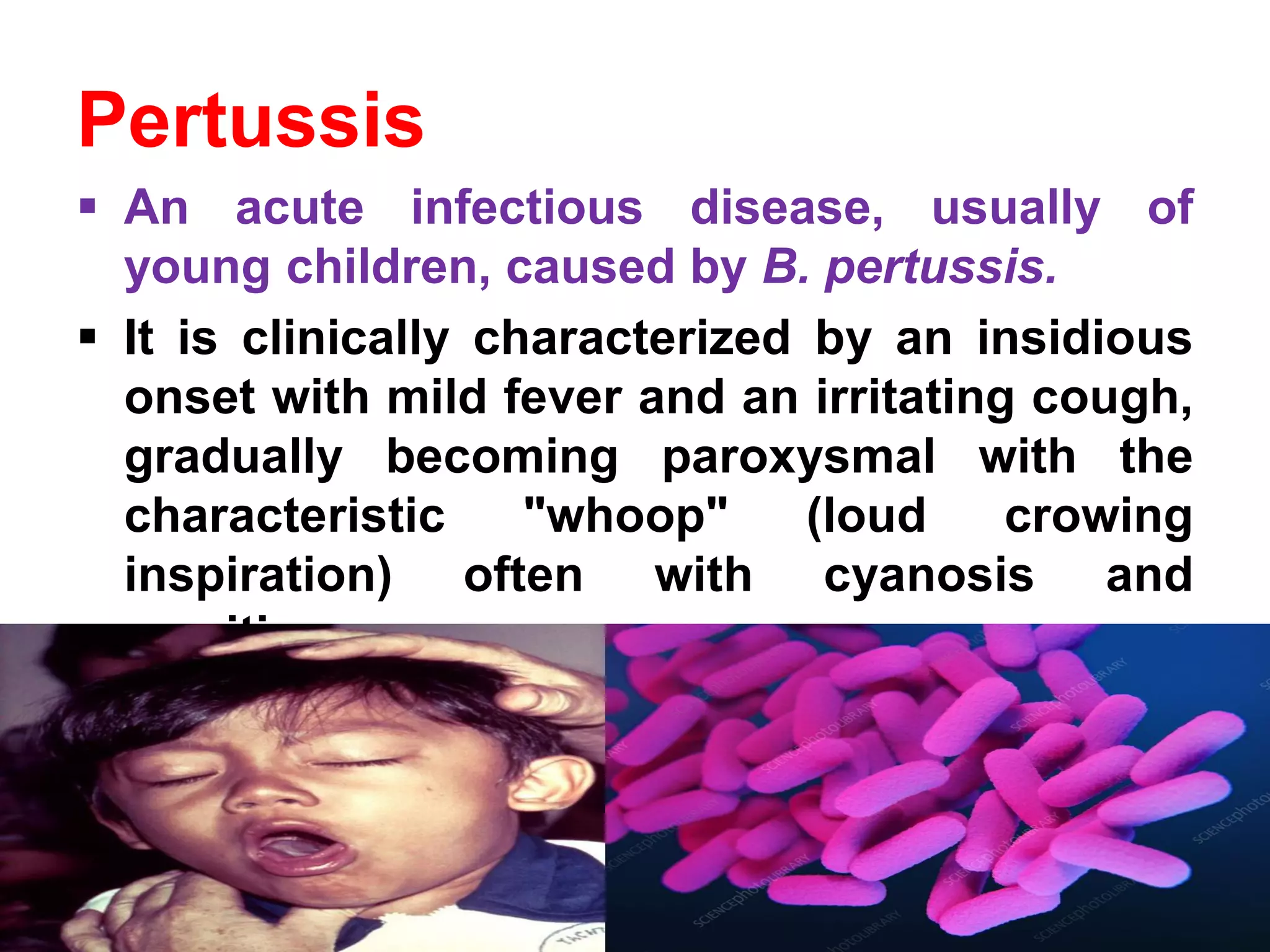 Pertusis ( Whooping Cough) | PDF