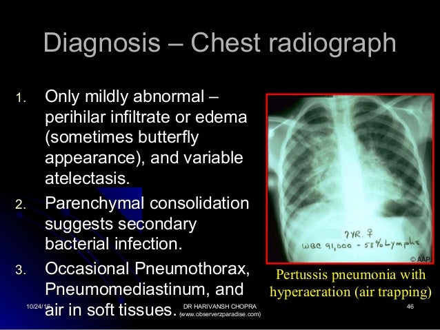 Pertussis (whooping cough) dr harivansh chopra