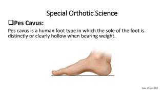 Pes cavus presentation.2017 27-april | PPTX