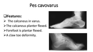 Pes cavus presentation.2017 27-april | PPTX