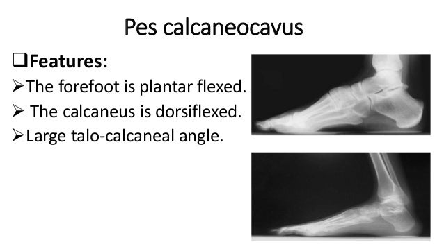 Pes cavus icd 10 - shedmasa