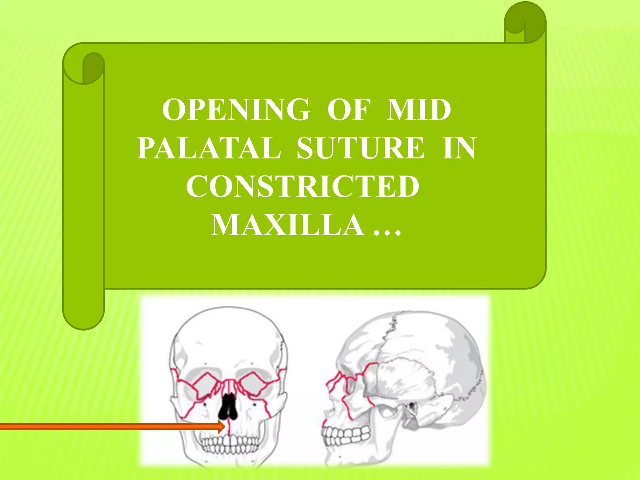HOW to measure CBCT BEFORE AND AFTER MID PALATAL SUTURE OPENING | PPTX