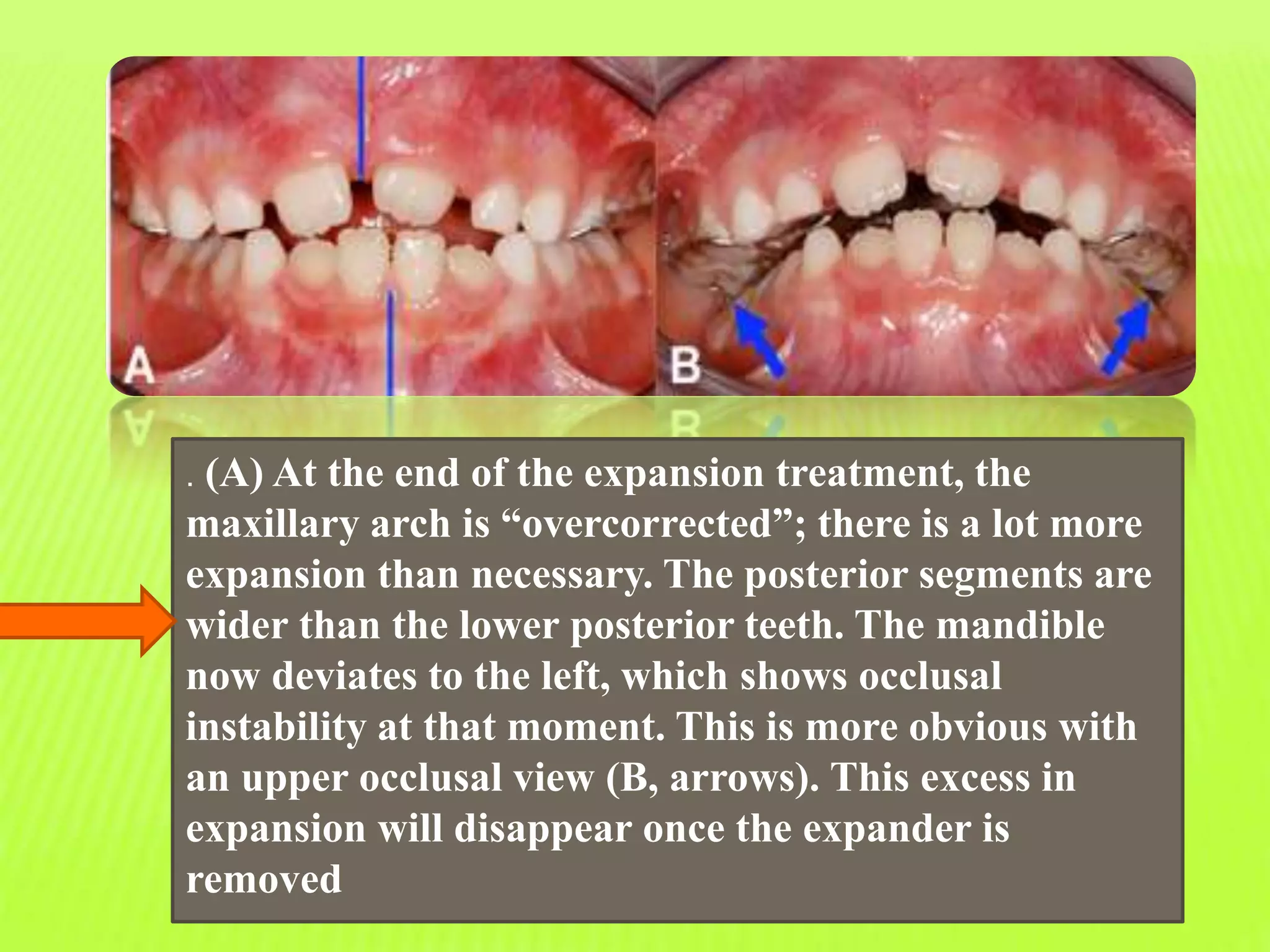 HOW to measure CBCT BEFORE AND AFTER MID PALATAL SUTURE OPENING | PPTX