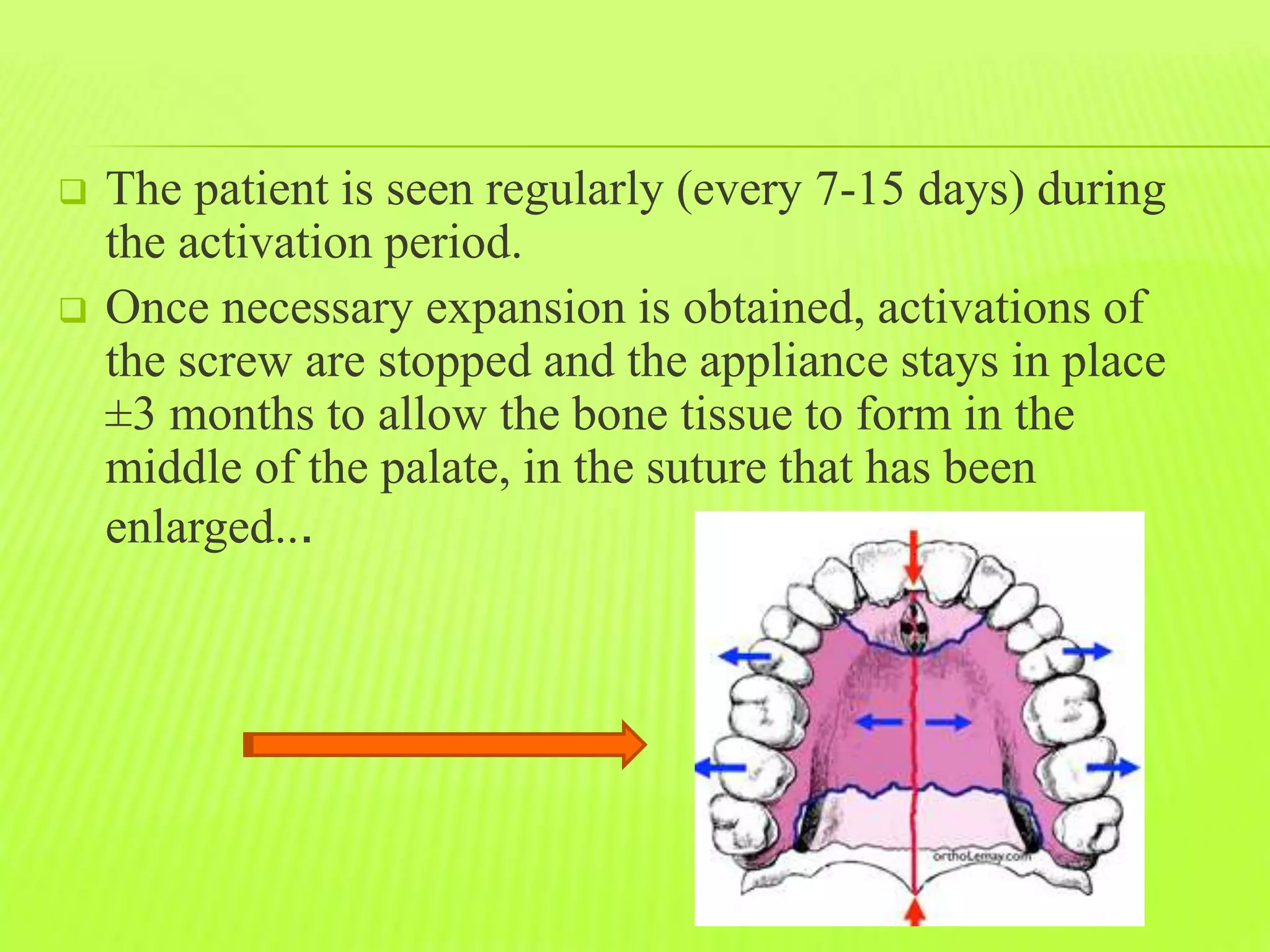 HOW to measure CBCT BEFORE AND AFTER MID PALATAL SUTURE OPENING | PPTX