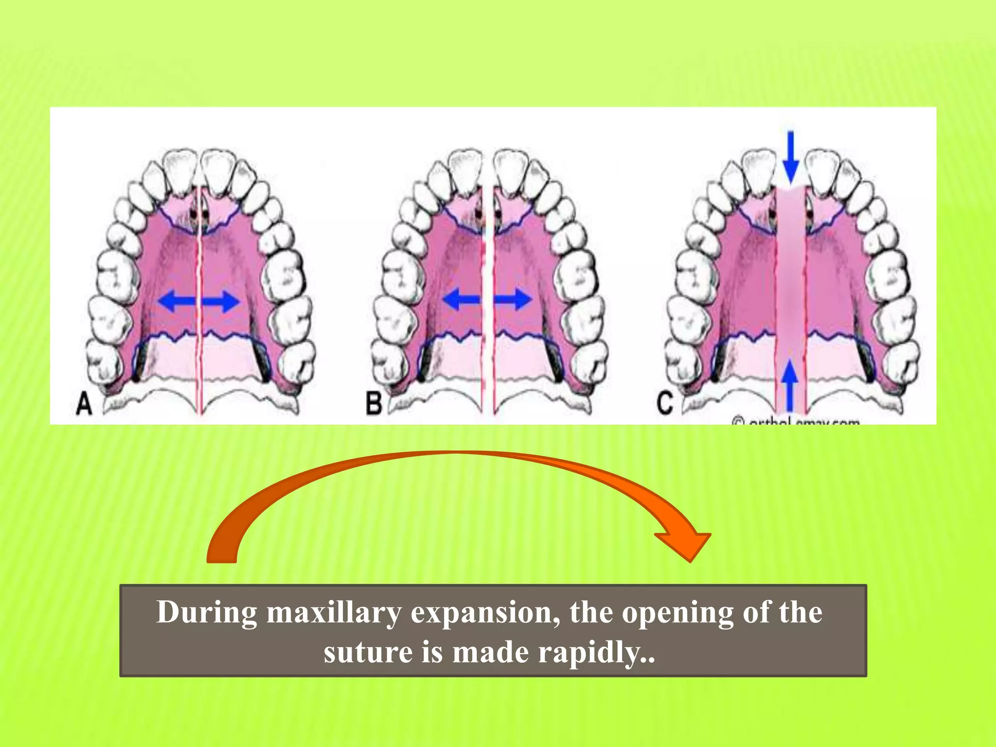 HOW to measure CBCT BEFORE AND AFTER MID PALATAL SUTURE OPENING | PPTX