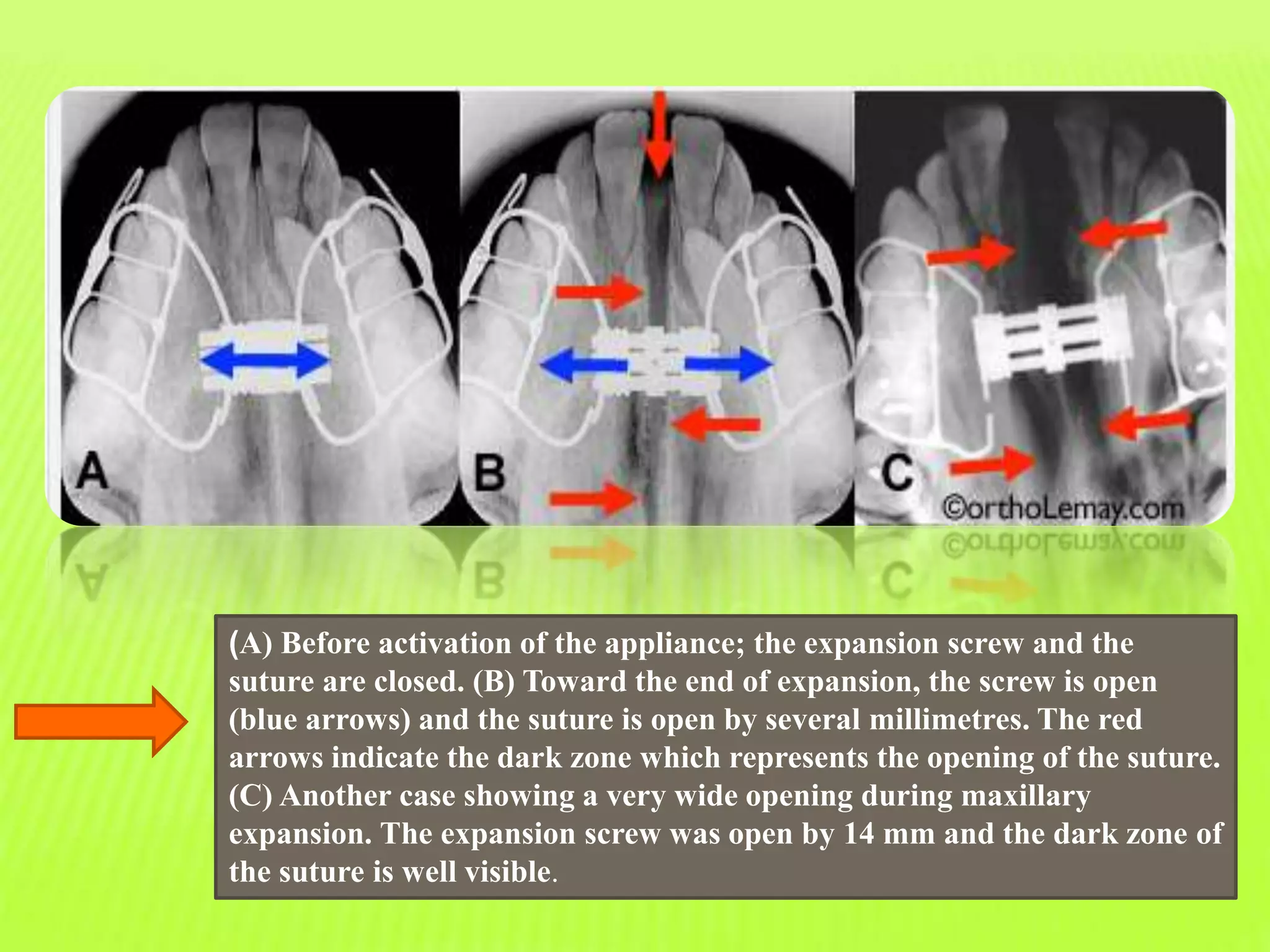 HOW to measure CBCT BEFORE AND AFTER MID PALATAL SUTURE OPENING | PPTX