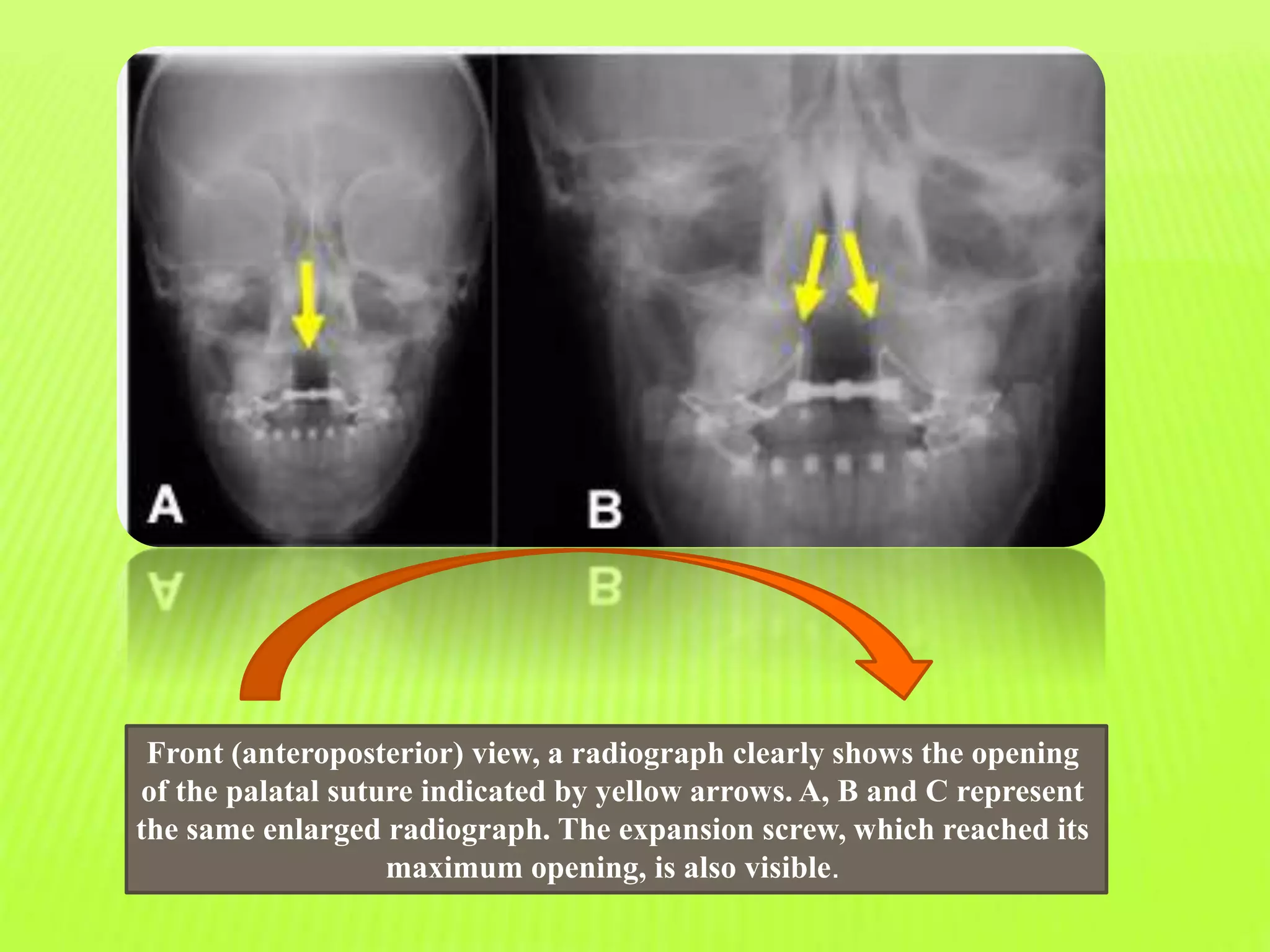 HOW to measure CBCT BEFORE AND AFTER MID PALATAL SUTURE OPENING | PPTX