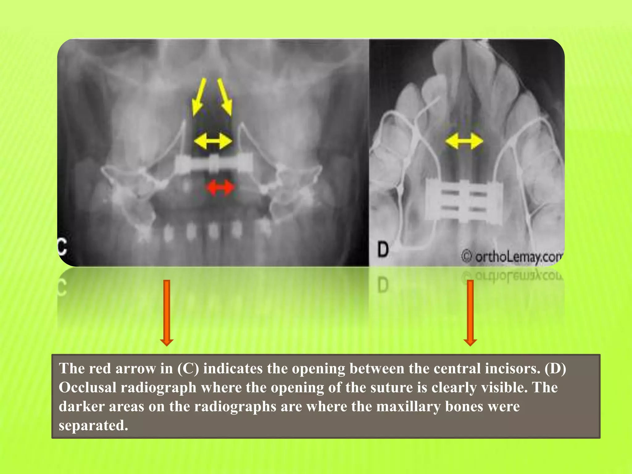 HOW to measure CBCT BEFORE AND AFTER MID PALATAL SUTURE OPENING | PPTX