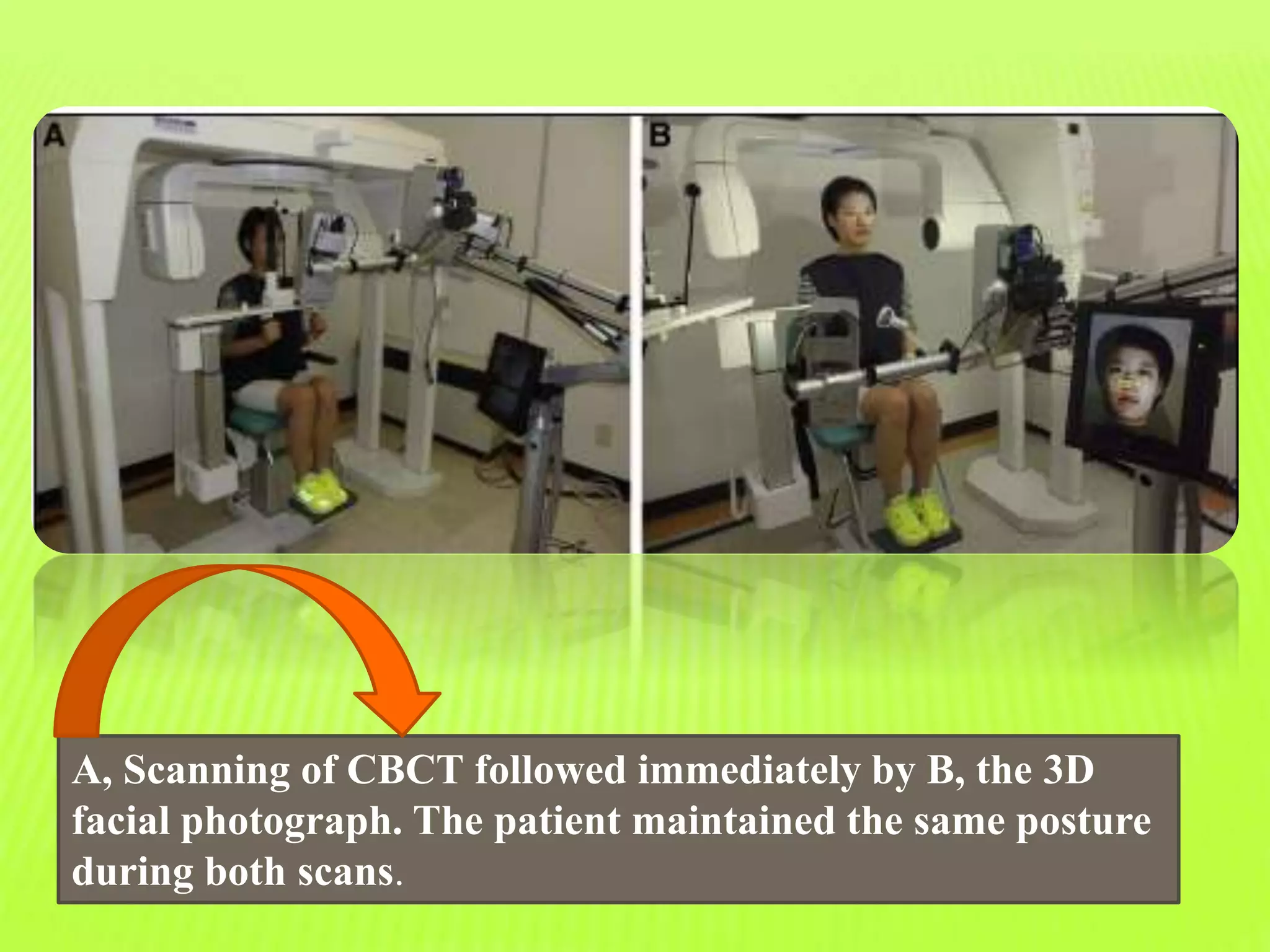 HOW to measure CBCT BEFORE AND AFTER MID PALATAL SUTURE OPENING | PPTX